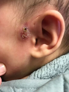 Preauricular Cysts and Ear Cysts - ENT 4 Kids