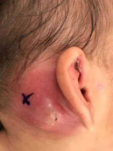Preauricular Cysts and Ear Cysts - ENT 4 Kids